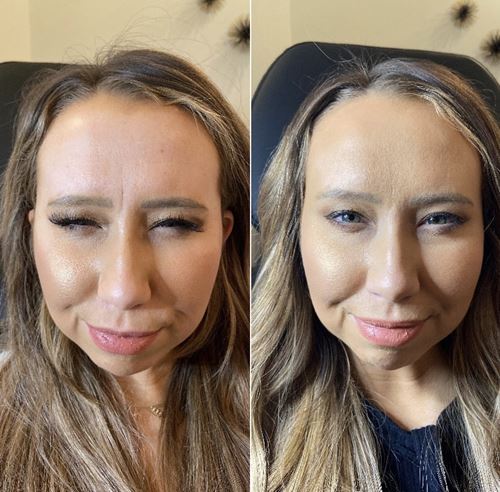 Dos & Don’ts of Botox in your 20s