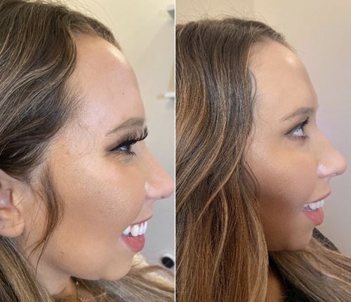 Dos & Don’ts of Botox in your 20s